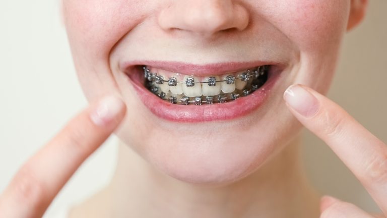 How Traditional Braces Correct Complex Bite and Alignment Issues